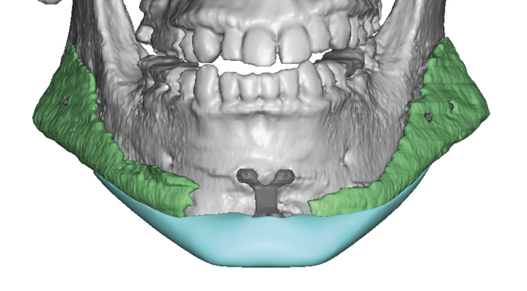 custom chin implant overlay front 2 Dr Barry Eppley - Explore Plastic ...