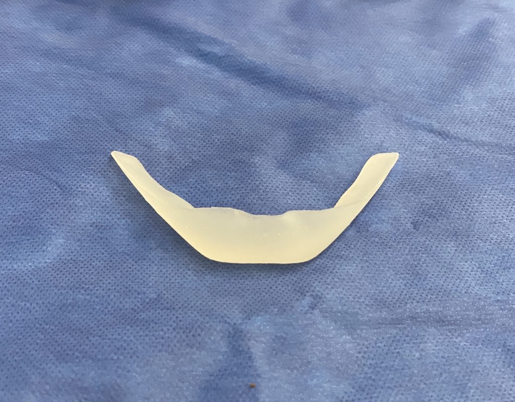 custom chin implant overlay intraop Dr Barry Eppley - Explore Plastic ...