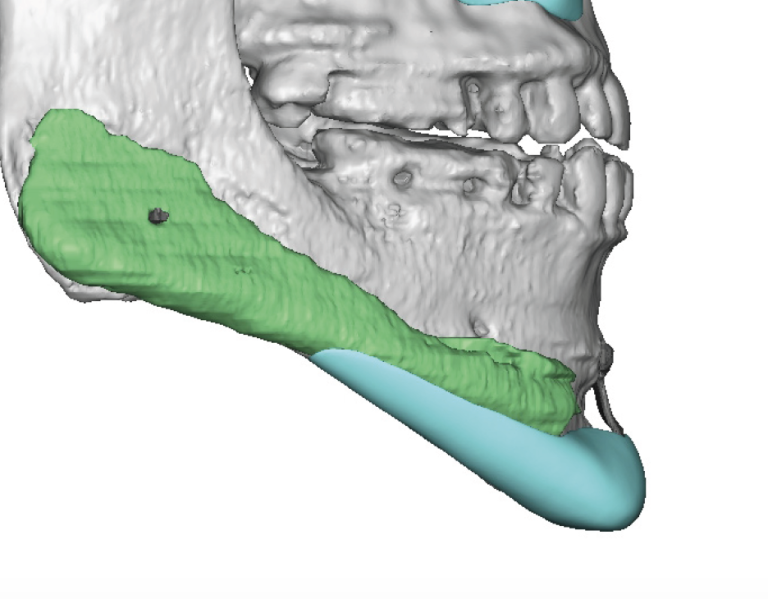 Plastic Surgery Case Study - Secondary Custom Chin Implant Overlay Of ...