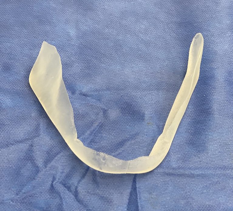 Plastic Surgery Case Study - Reshaping/Derotating The Steep Mandibular ...