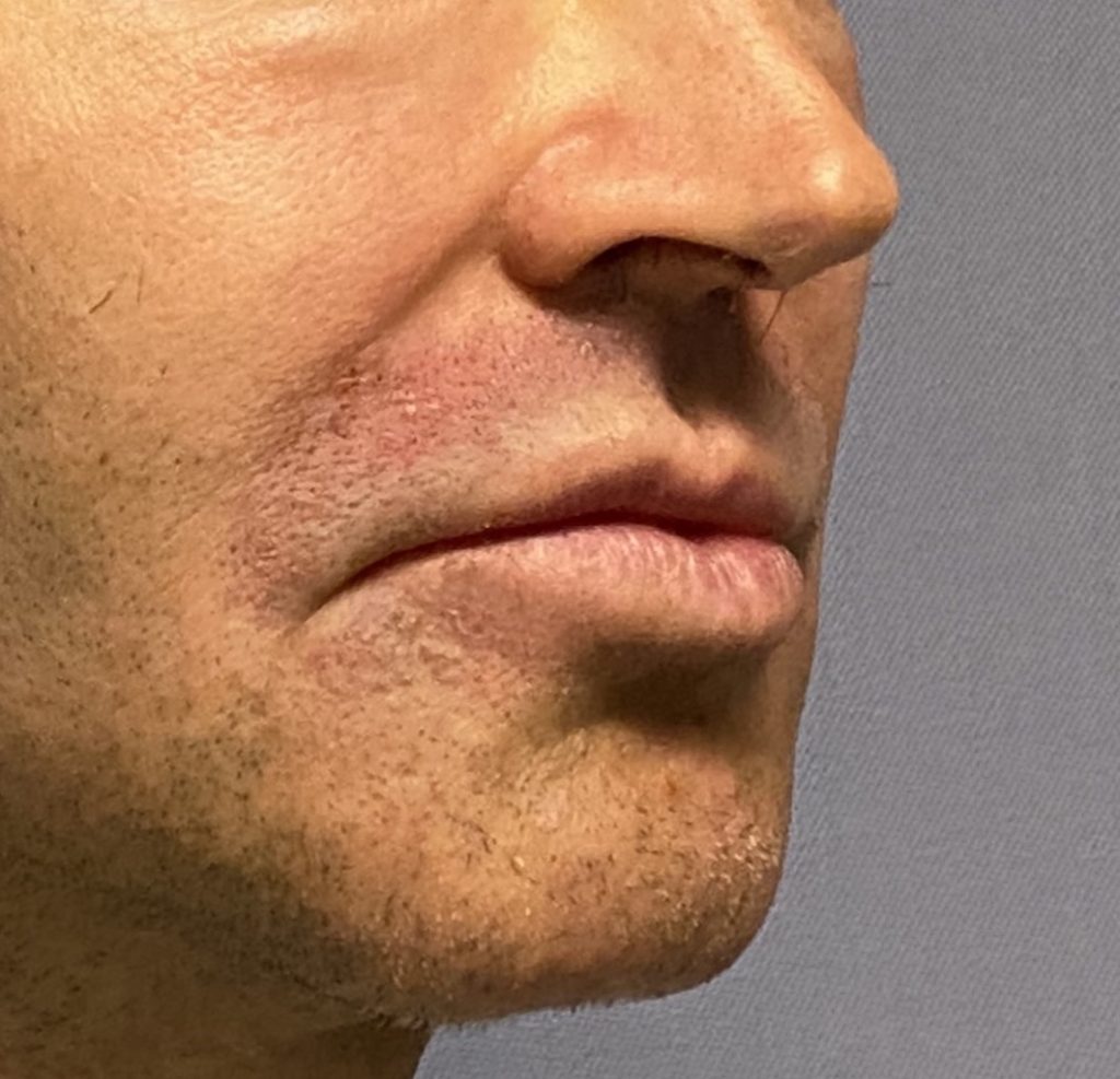 The ePTFE Paranasal Implant for Deeper Nasolabial Folds - Explore ...