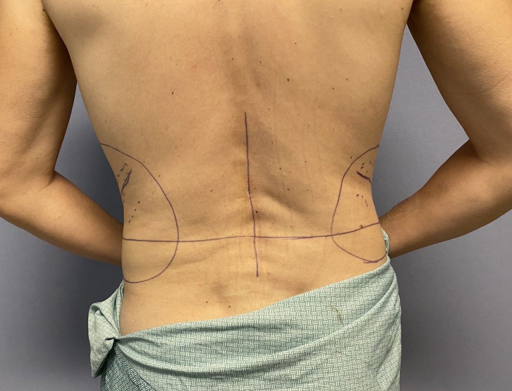 Waistline Narrowing With Rib Removal Vs Rib Fracture Surgery How Are They Different Explore