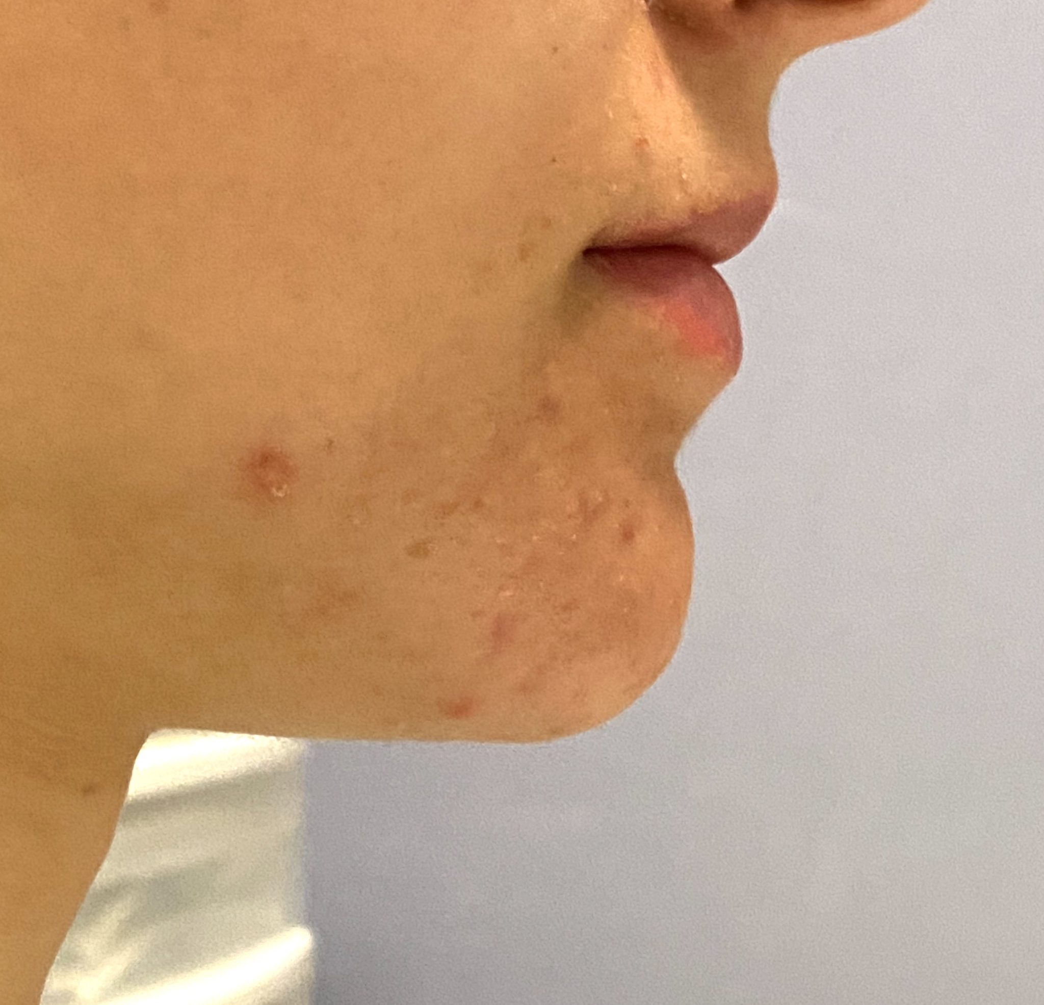 Plastic Surgery Case Study - Correction of Exaggerated Dynamic Chin Pad ...