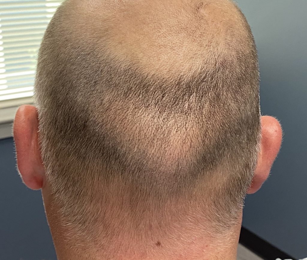 Plastic Surgery Case Study - Reduction of the Male Large Occipital Knob ...