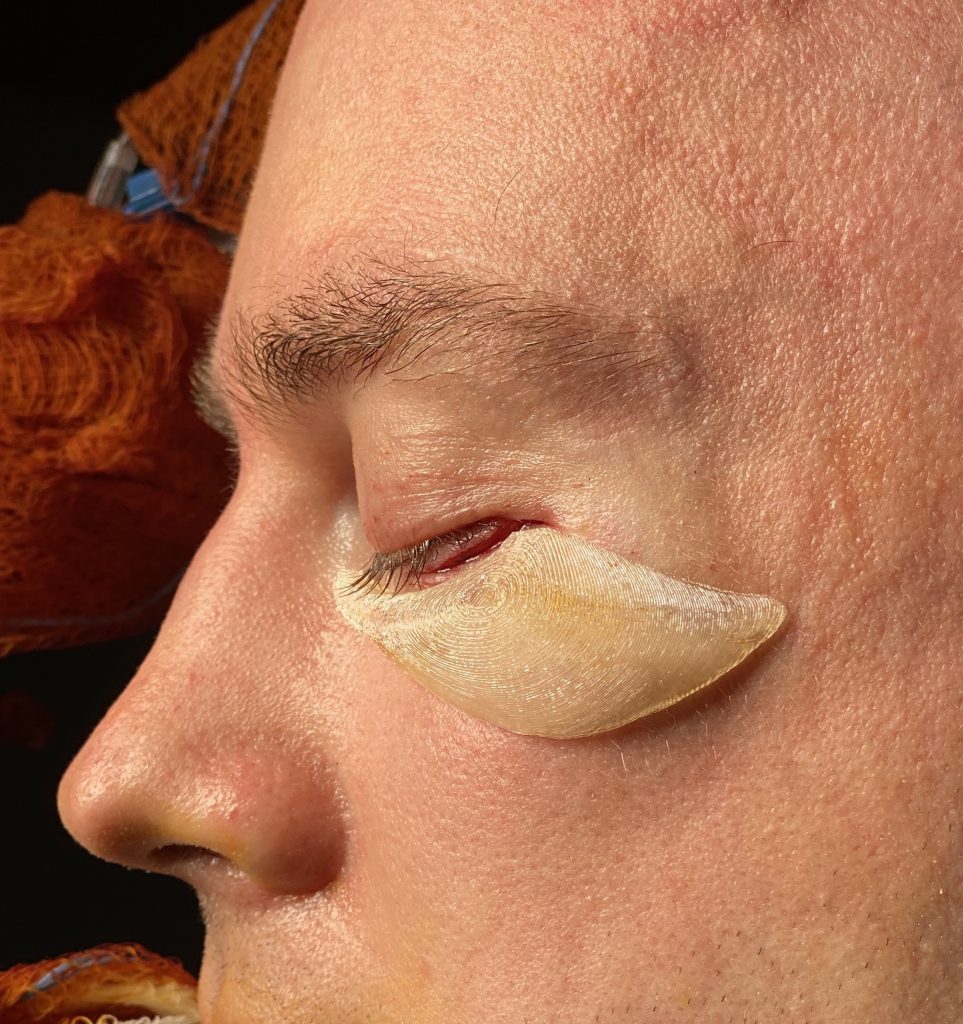 Plastic Surgery Case Study - Custom Infra-Orbital Malar and Jawline ...