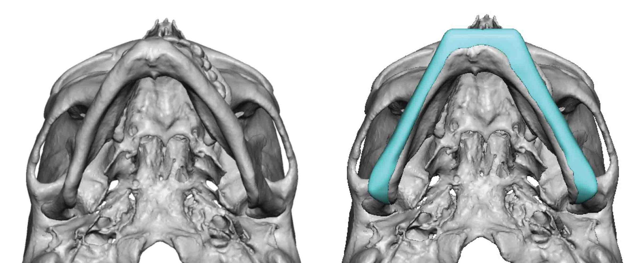 The Submental Incision in Custom Jawline Implant Placements - Explore ...