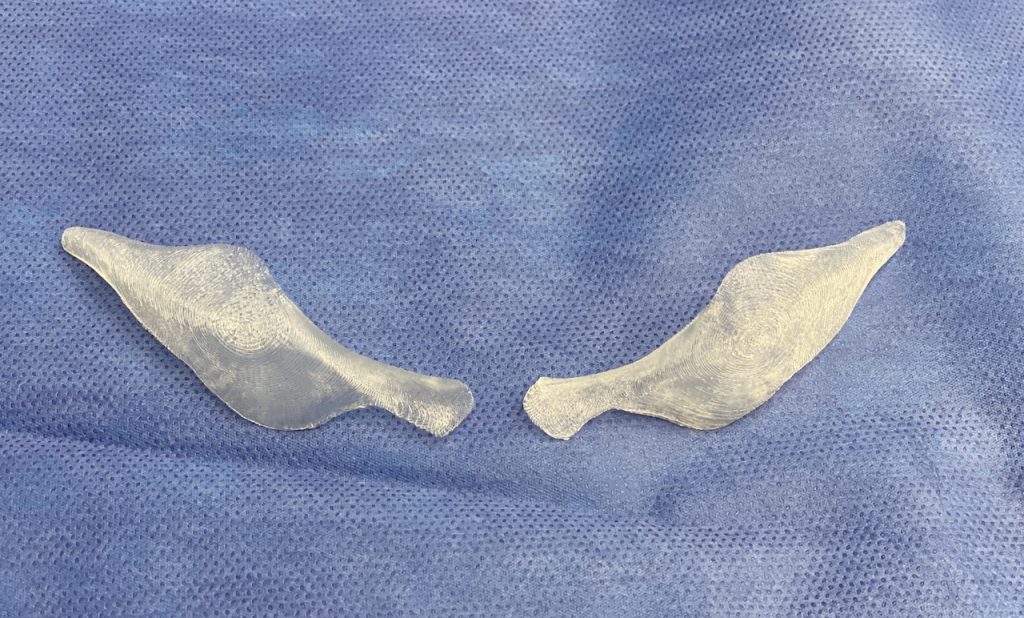 The Lower Eyelid Incision Used In Custom Infraorbital Rim-Malar ...