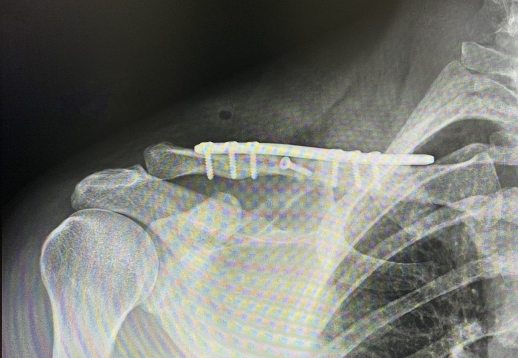 Plastic Surgery Case Study - Shoulder Widening By Clavicle Lengthening ...