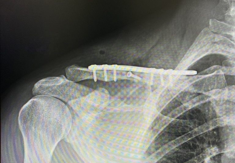 Plastic Surgery Case Study - Shoulder Widening By Clavicle Lengthening ...