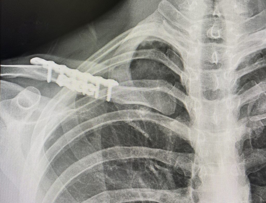 Plastic Surgery Case Study - Clavicle Reduction Osteotomies for ...