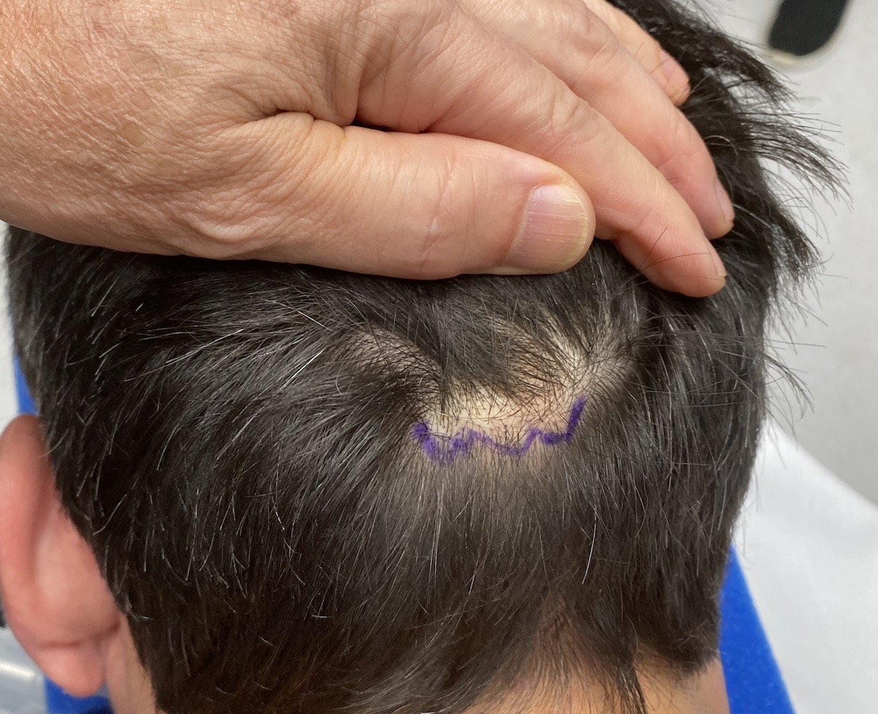 Plastic Surgery Case Study - Occipital Knob Skull Reduction in a Thin ...