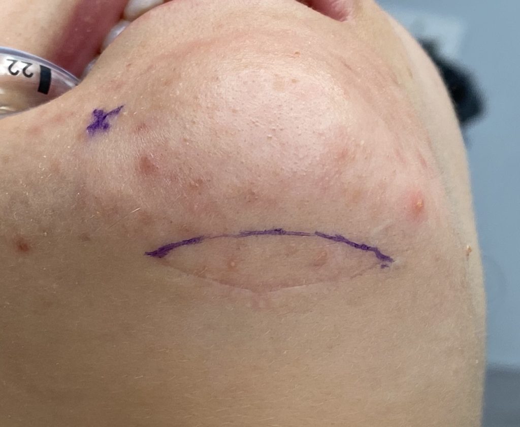 Plastic Surgery Case Study - Correction of Exaggerated Dynamic Chin Pad ...