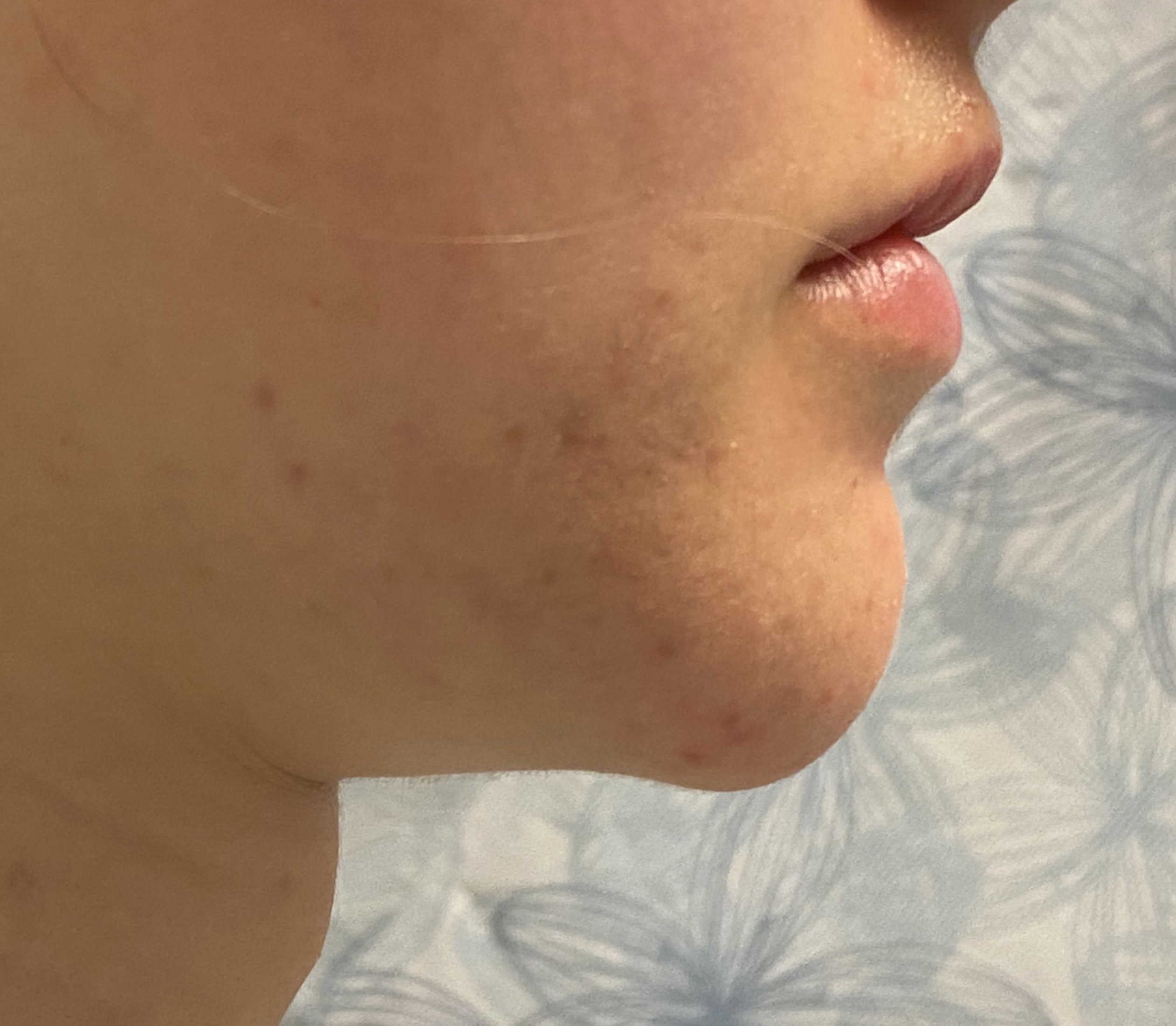 soft tissue chn pad excess after intraoral chin reducion side view Dr ...