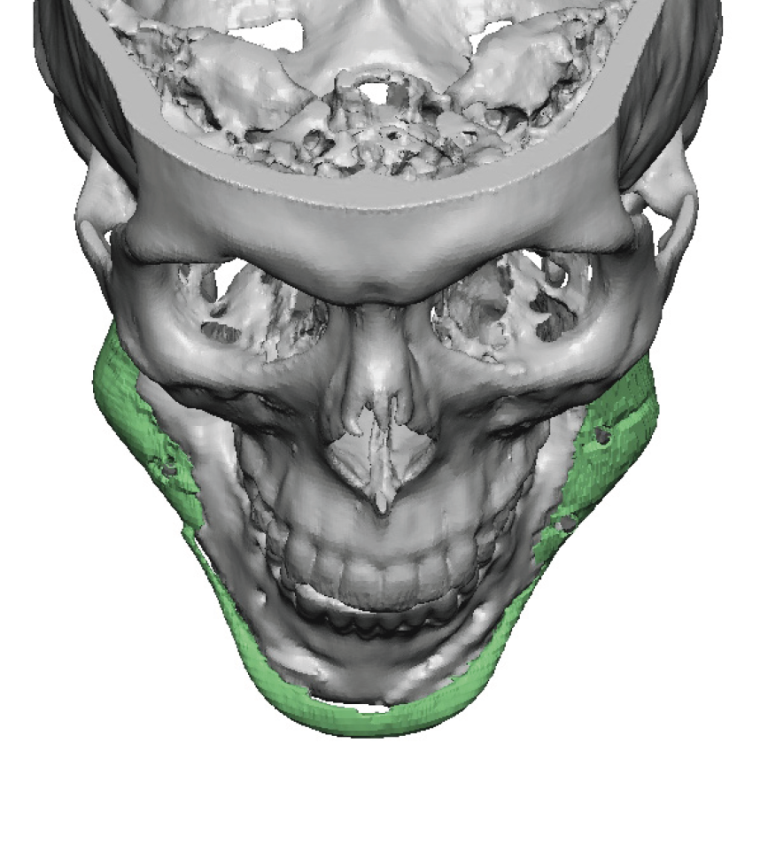 standard chin and jaw angle implants 3D CT scan top view Dr Barry ...