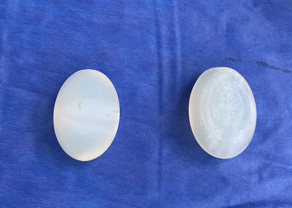 Plastic Surgery Case Study Placement Of Custom Testicle Implants In A