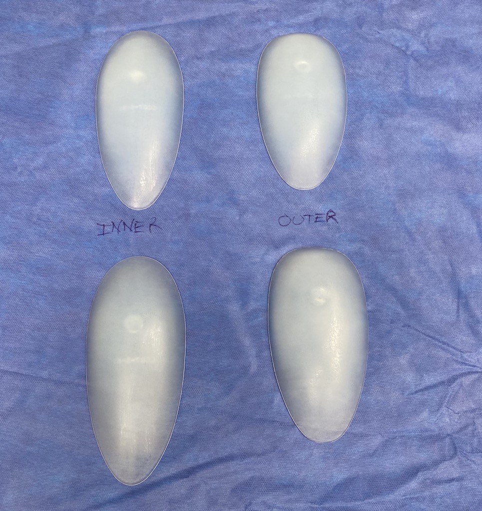 Plastic Surgery Case Study - 4 Implant Male Calf Augmentation - Explore ...