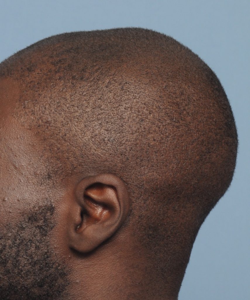 Technical Strategies - The Occipital Skull Extension Implant for Back ...