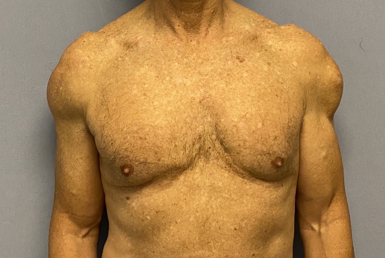 Plastic Surgery Case Study - Replacing Malpositioned and Fractured ...