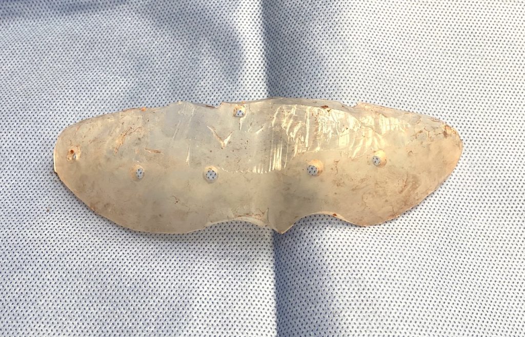 Technical Strategies - The Occipital Skull Extension Implant for Back ...