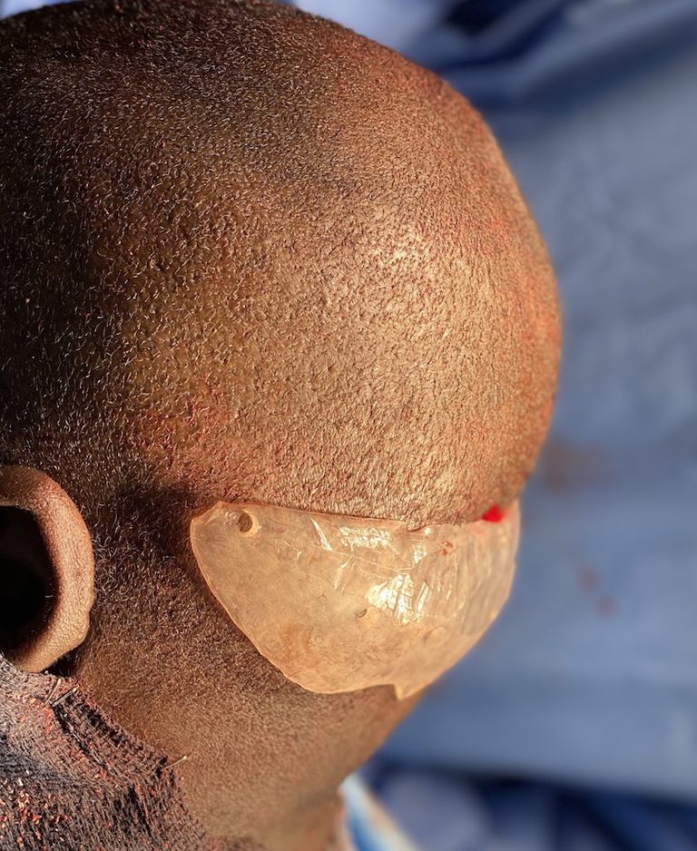 Technical Strategies - The Occipital Skull Extension Implant for Back ...