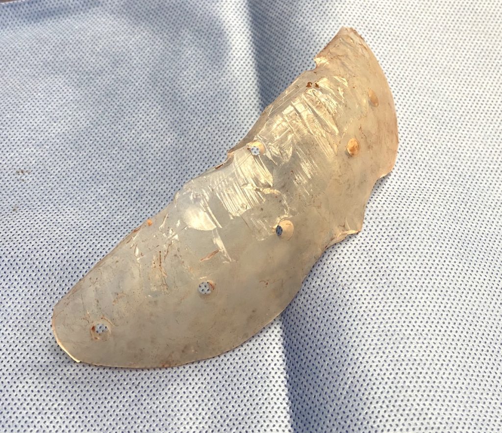 Technical Strategies - The Occipital Skull Extension Implant for Back ...