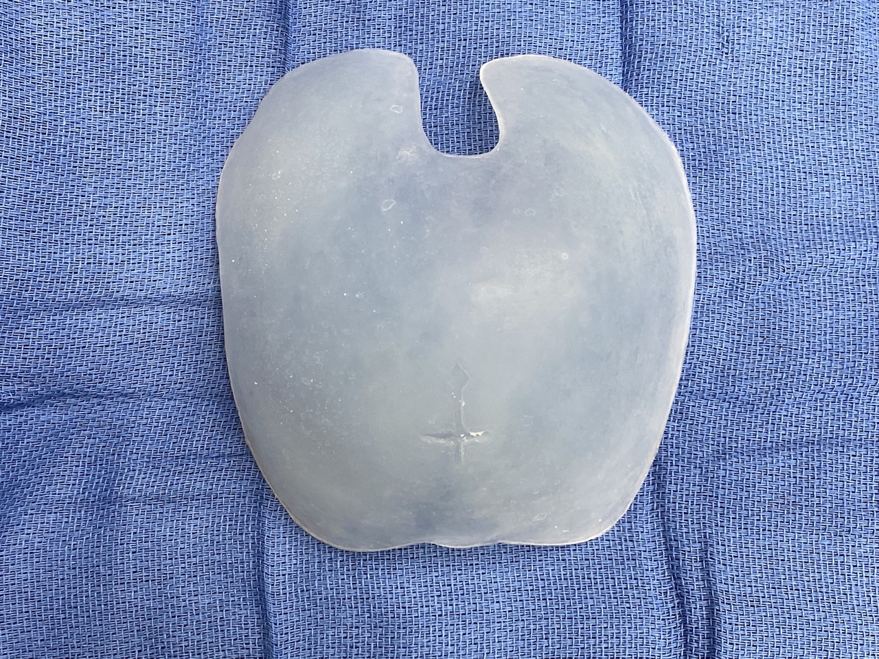 Plastic Surgery Case Study - Custom Skull Implant Correction of ...