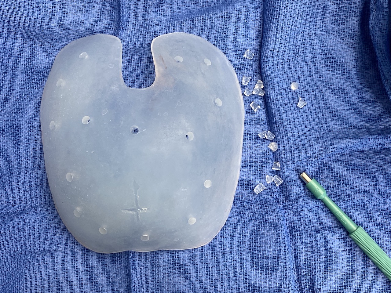 Plastic Surgery Case Study - Custom Skull Implant Correction of ...