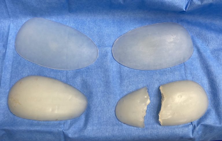 Plastic Surgery Case Study - Replacing Malpositioned and Fractured ...