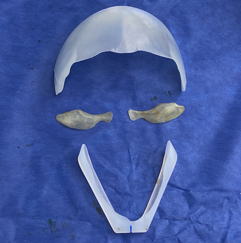 Three-Level Custom Facial Implants For Total Facial Reshaping - Explore ...