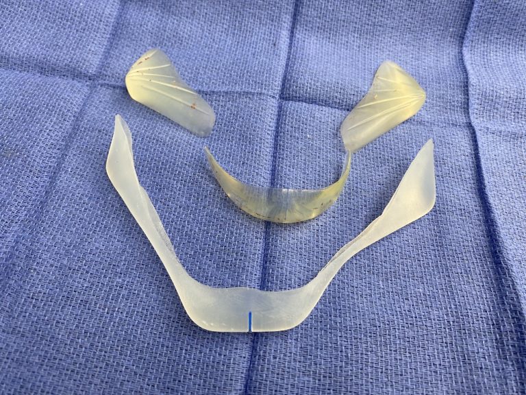 Plastic Surgery Case Study - The Different Effects of Standard vs ...