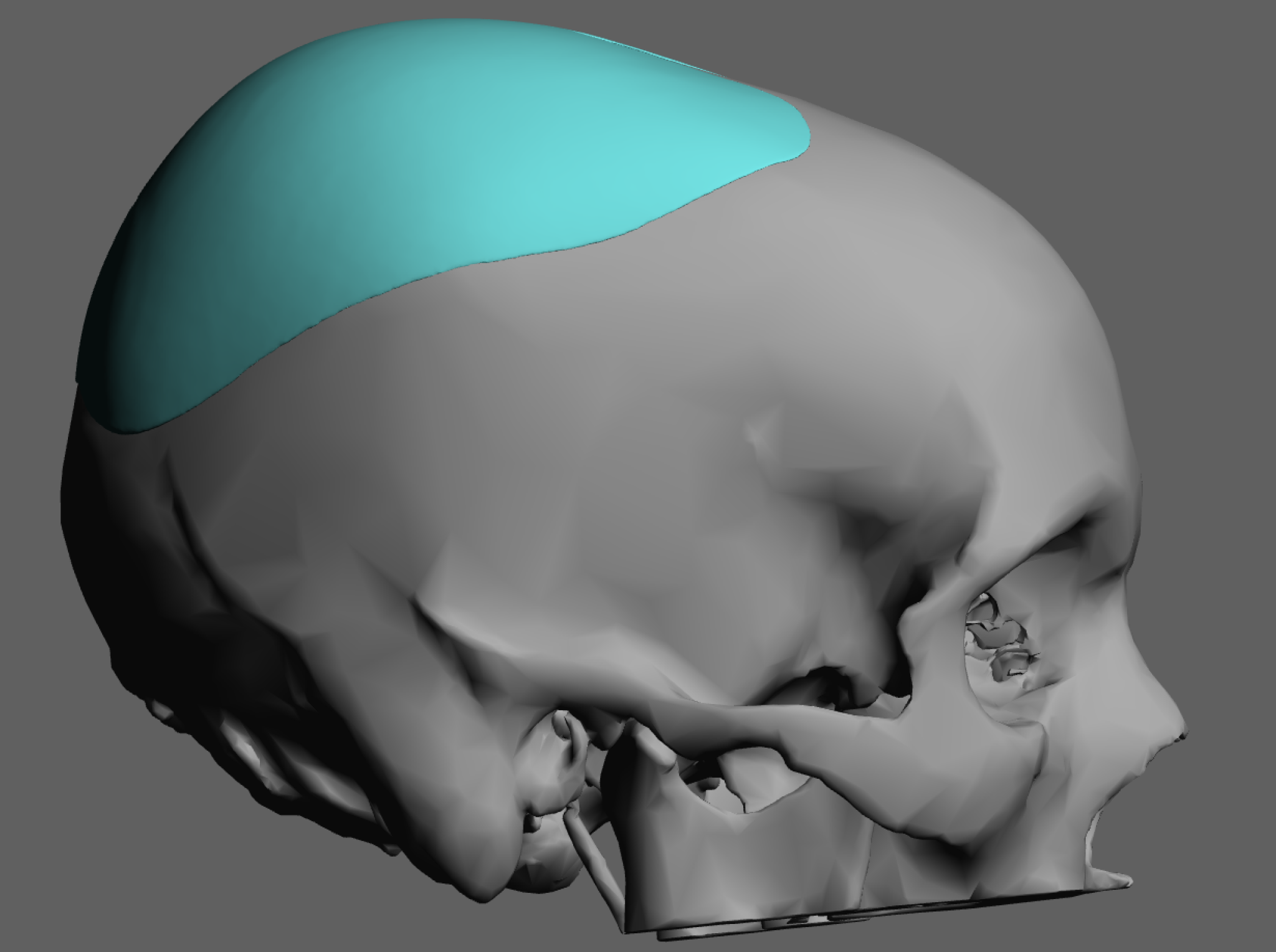 Plastic Surgery Case Study - Custom Skull Implant Correction of ...