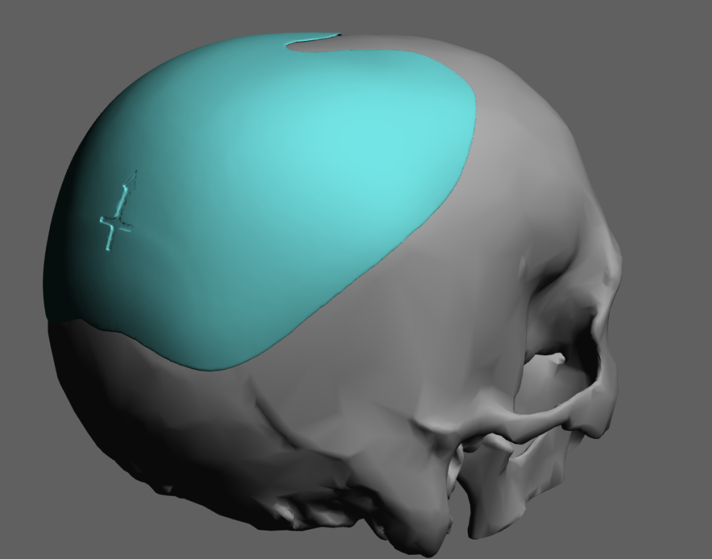 Plastic Surgery Case Study - Custom Skull Implant Correction of ...