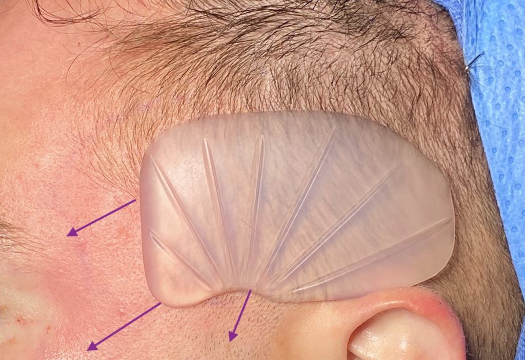 extended temporal implant pocket location Dr Barry Eppley - Explore ...