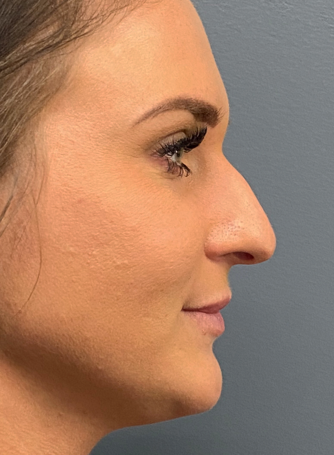 Plastic Surgery Case Study - Enabling A Faster Early Recovery in ...