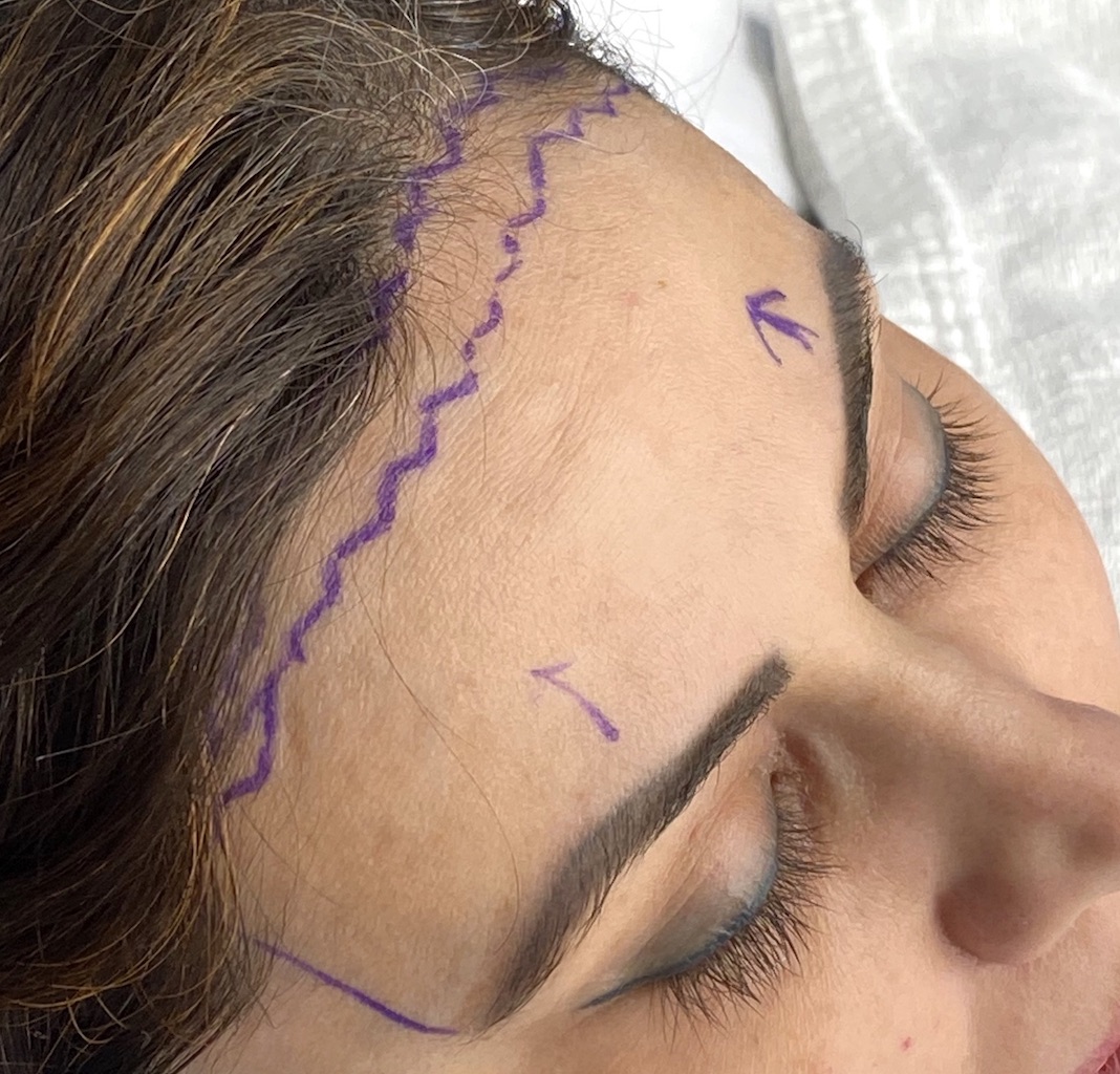 female hairline advancement browlift left oblique 1 Dr Barry Eppley ...