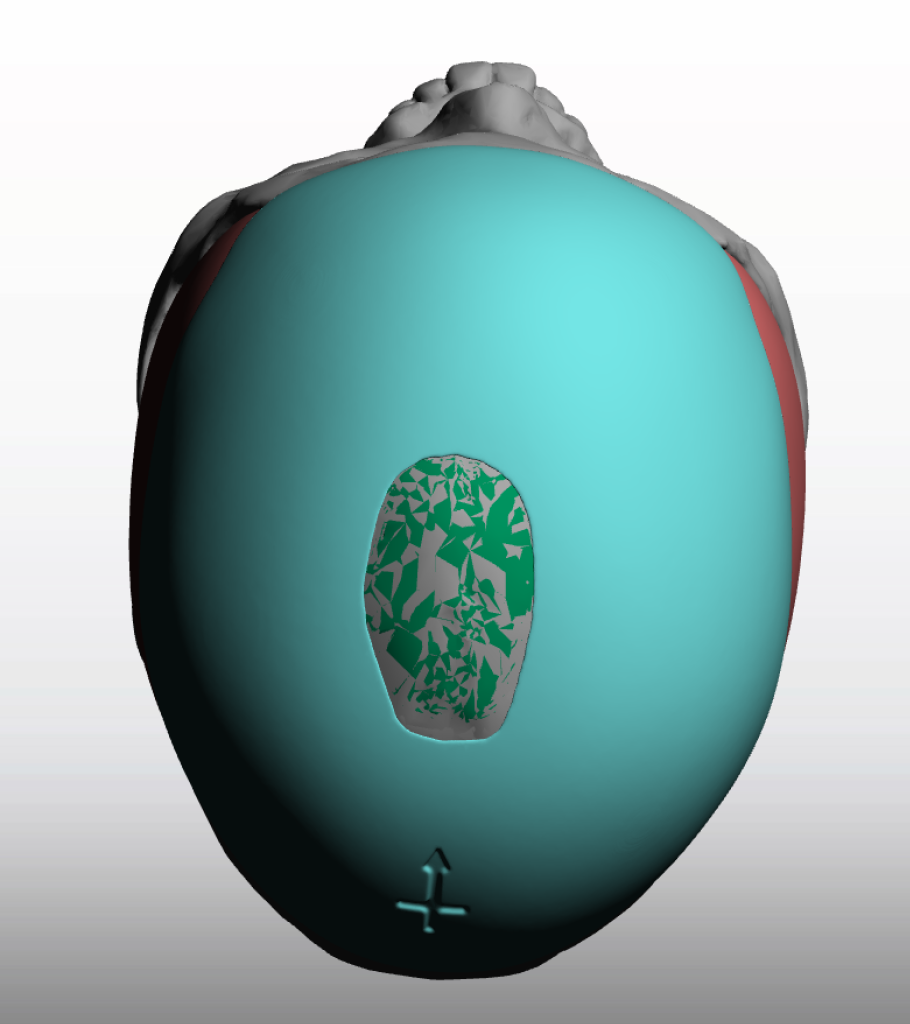 Technical Strategies - The Split Placement Technique in Large Surface ...