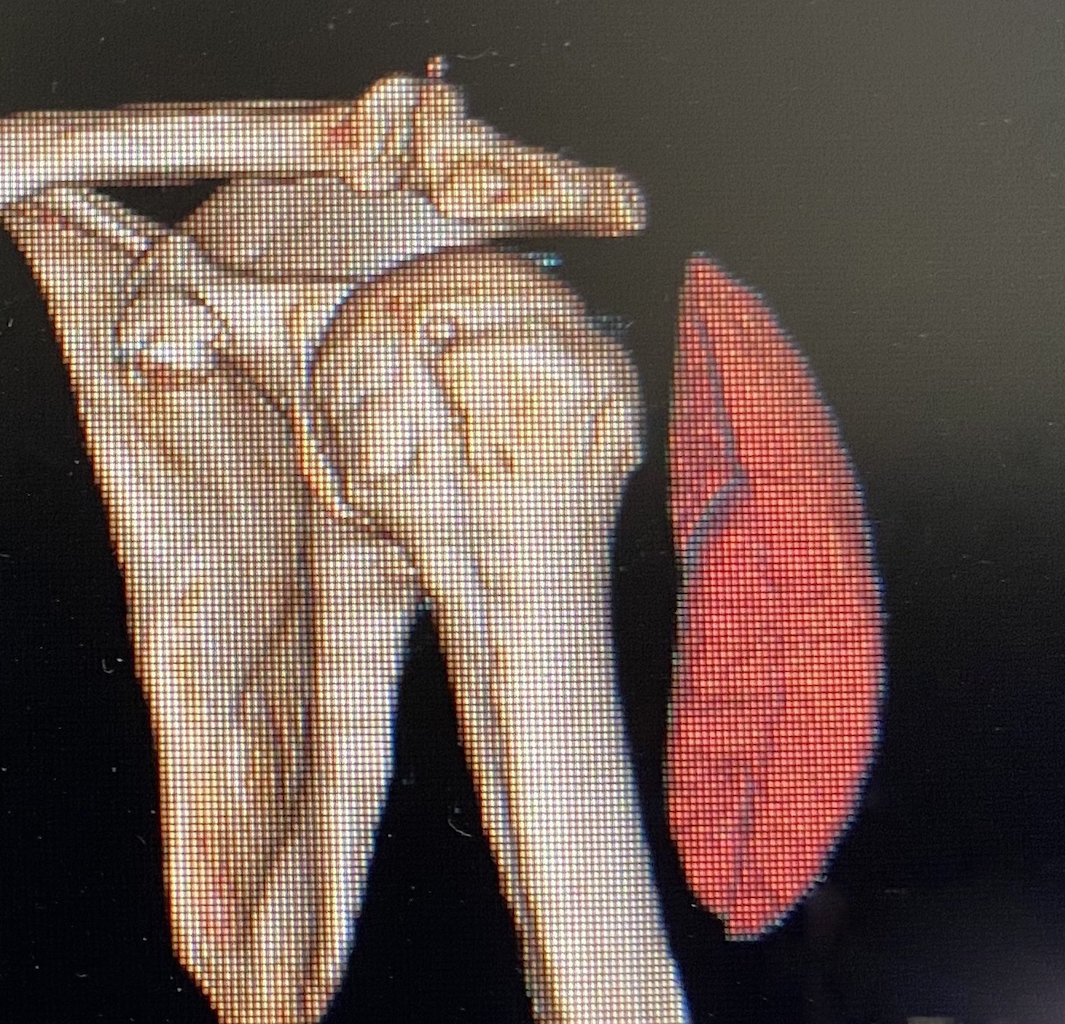 Plastic Surgery Case Study - Replacing Malpositioned and Fractured ...