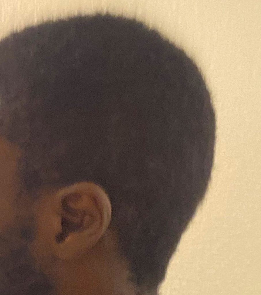 Technical Strategies - The Occipital Skull Extension Implant for Back ...