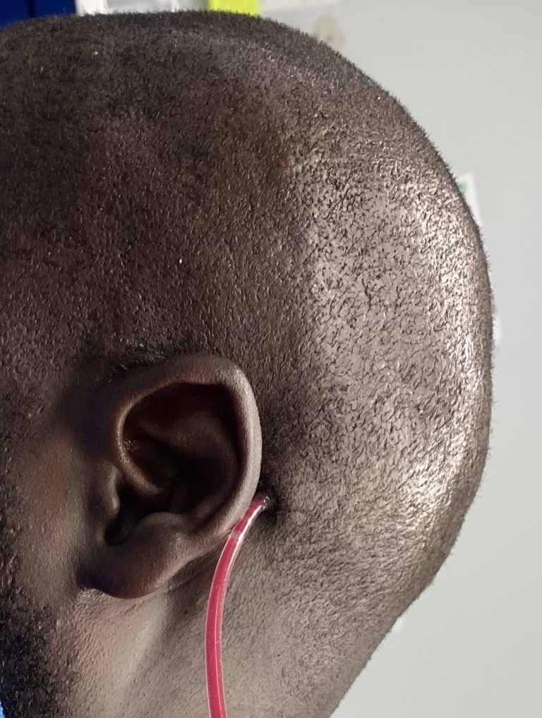 Technical Strategies - The Occipital Skull Extension Implant for Back ...