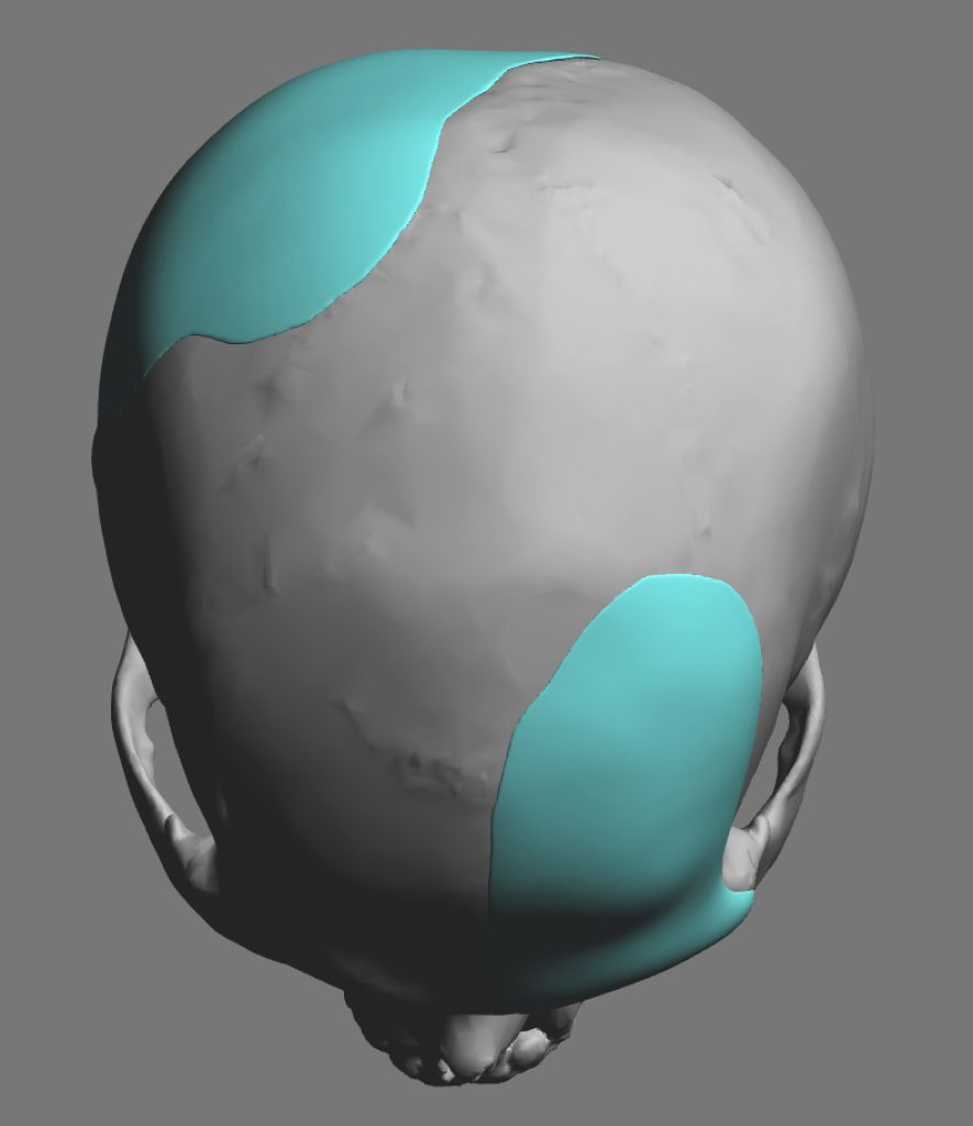 Plastic Surgery Case Study - Complete Adult Plagiocephaly Correction ...