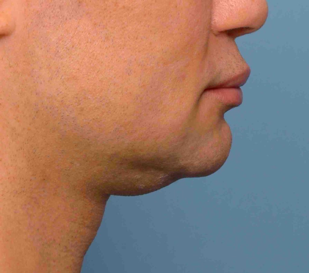 Plastic Surgery Case Study - The Necklifting Effect of The Vertical ...