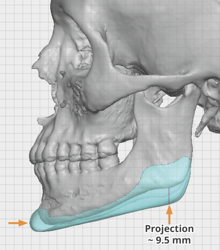 Plastic Surgery Case Study - The Necklifting Effect of The Vertical ...
