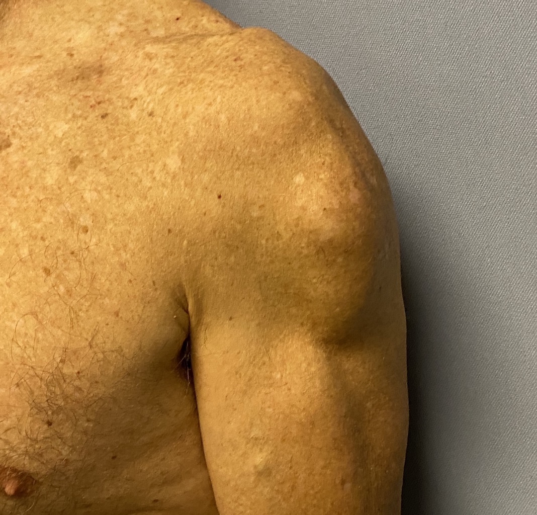 Plastic Surgery Case Study - Replacing Malpositioned and Fractured ...