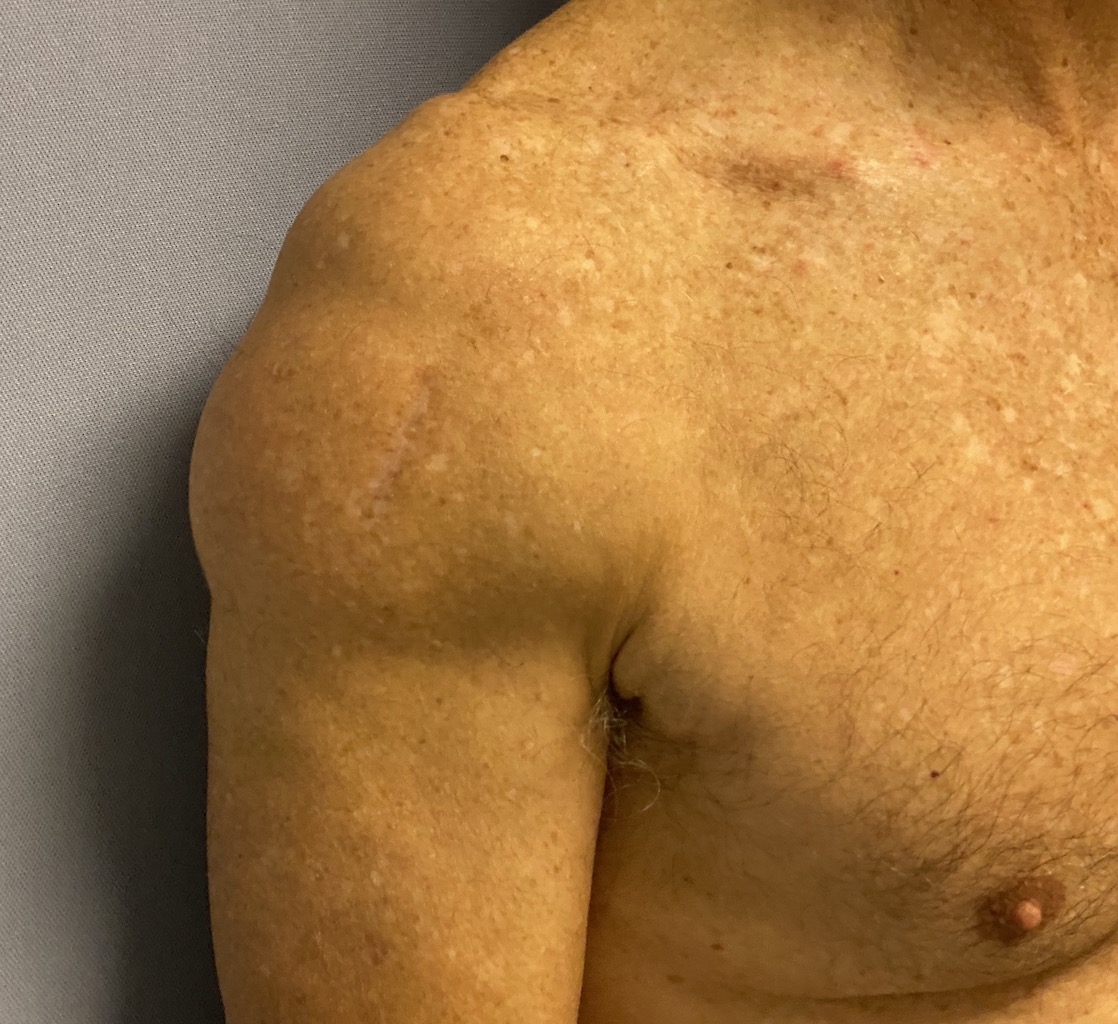 Plastic Surgery Case Study - Replacing Malpositioned and Fractured ...