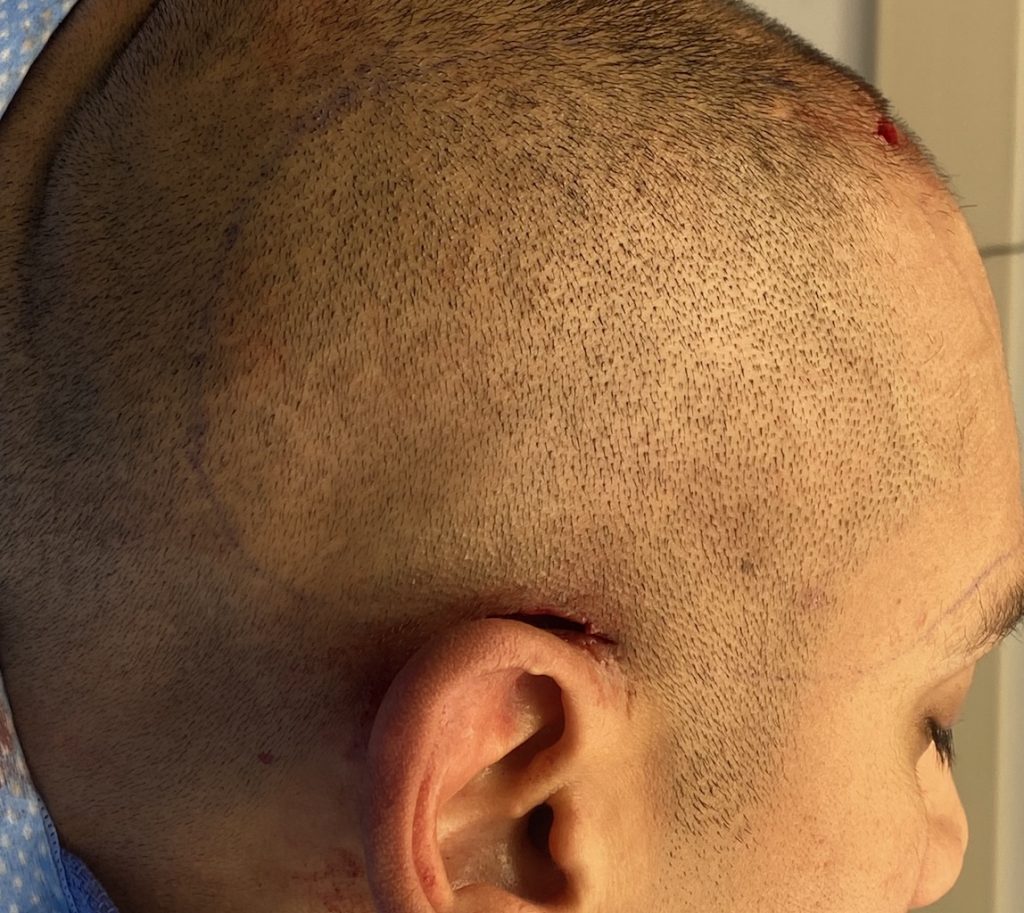 Plastic Surgery Case Study - Custom Extended Temporal-Forehead Implant ...