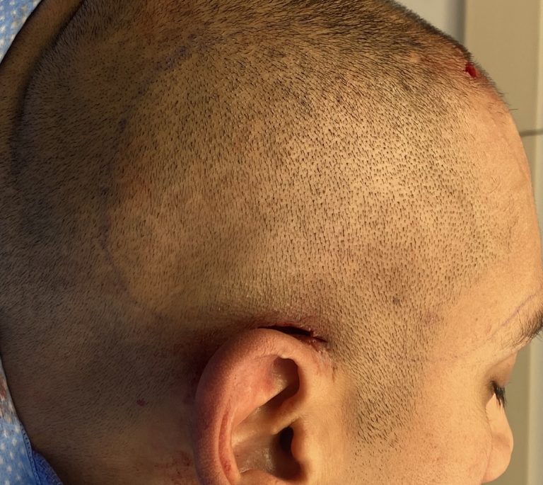 Plastic Surgery Case Study - Custom Extended Temporal-Forehead Implant ...