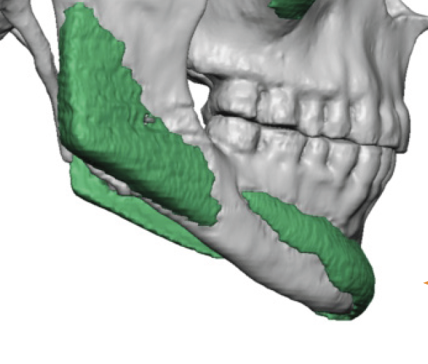 Plastic Surgery Case Study - The Different Effects of Standard vs ...