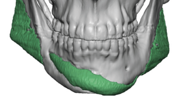 Plastic Surgery Case Study - The Different Effects of Standard vs ...