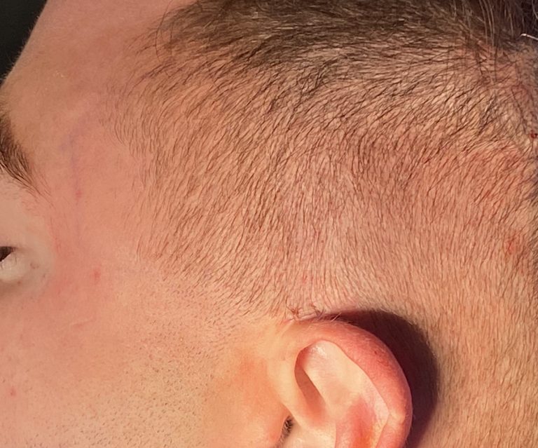 Plastic Surgery Case Study - The Postauricular Incision for Male ...