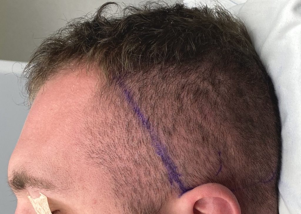 Plastic Surgery Case Study - Reduction of the Wide/Convex Side of the ...